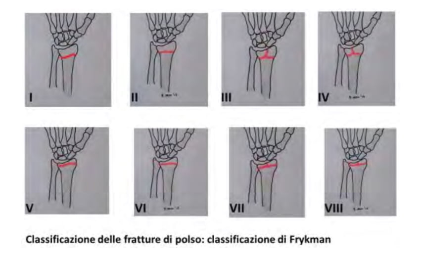 Polso: la frattura e la chirurgia di salvataggio