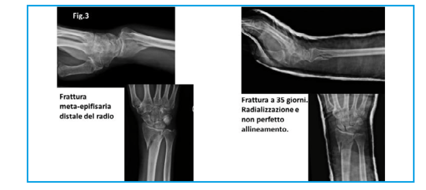 Polso: la frattura e la chirurgia di salvataggio